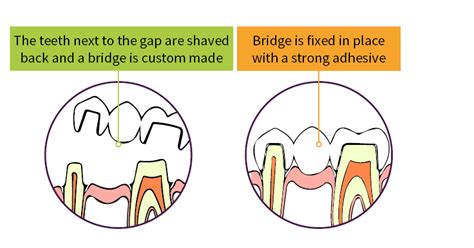 Conventional Bridge