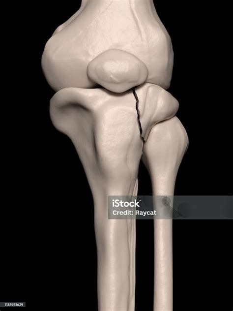 Proximal Tibia Fraktur Dataran Tinggi Tibial Foto Stok Unduh Gambar