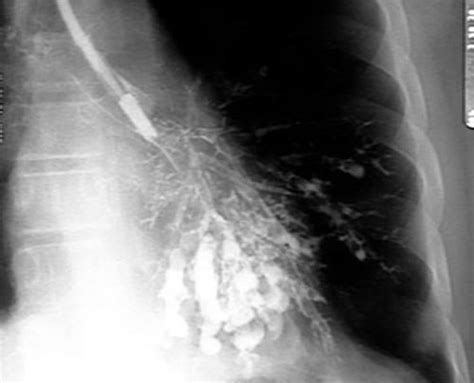 Bronchiectasis