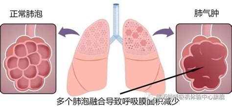 慢阻肺为什么先出现缺氧后出现二氧化碳潴留？ 知乎