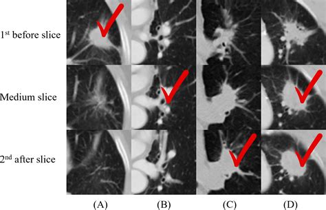 A Multi Kernel And Multi Scale Learning Based Deep Ensemble Model For Predicting Recurrence Of