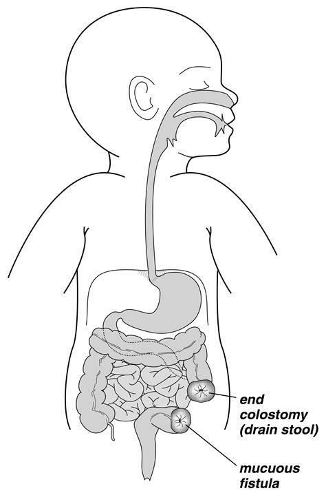 Mucous Fistula Stoma