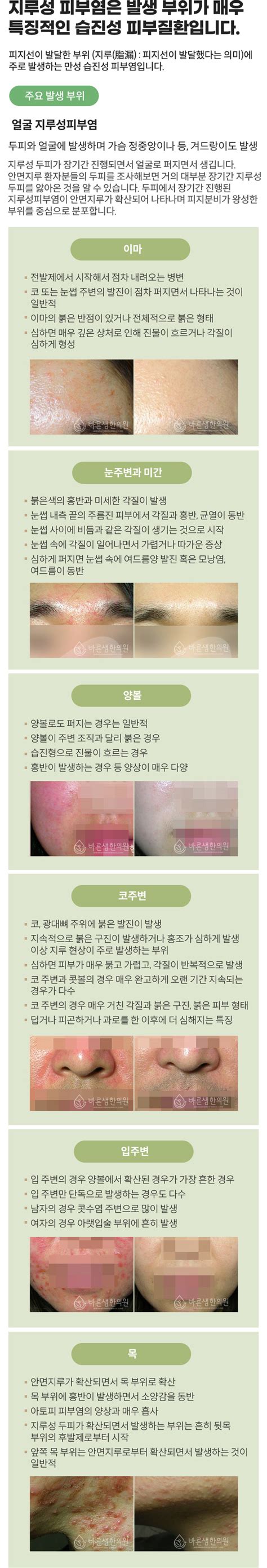 지루성 피부염 And 두피염의
