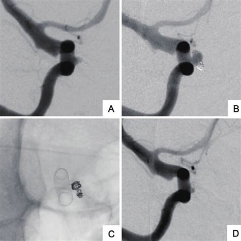 Digital Subtraction Angiography DSA Images Of Endovascular Treatment Download Scientific