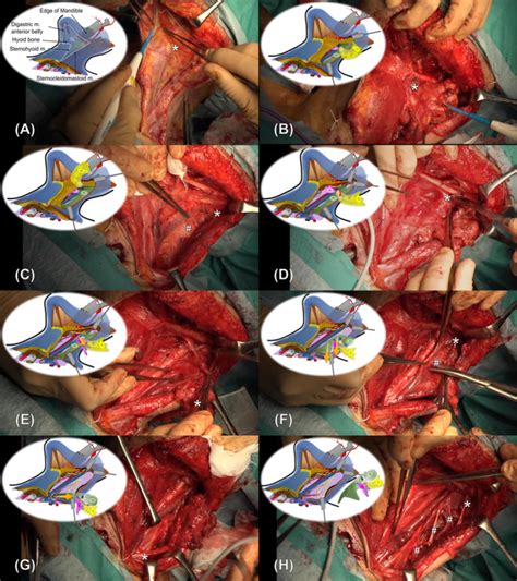 Medial‐to‐lateral Approach In Neck Dissection Pmc