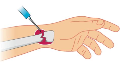 Hematoma Block Internet Book Of Msk Ultrasound