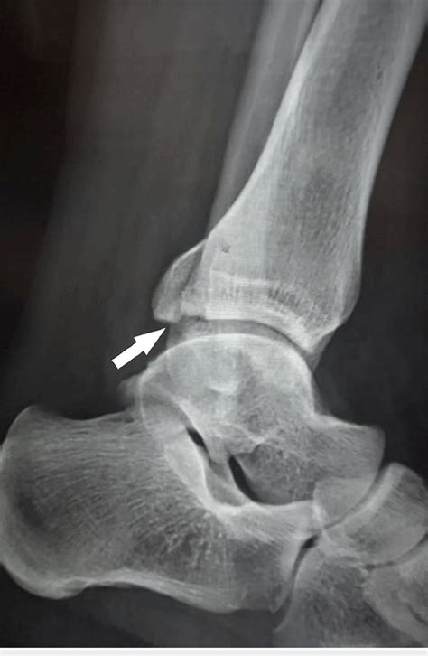 Lateral View Radiograph Of The Left Ankle Shows Posterior Malleolar