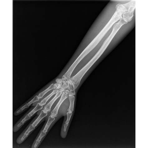 Broken Arm 1 Buyxraysonline