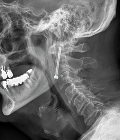 Pinned Spinal Fracture Photograph By Zephyr Science Photo Library