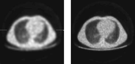 Quantifying Spect Radiology Key
