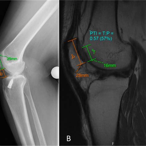 Lateral Knee Radiographs And Mri Demonstrating The Measurement Of Cdi