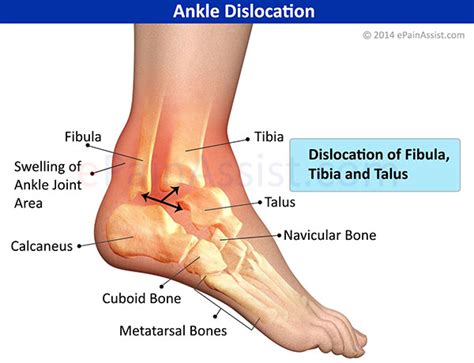 Dislocated Ankle Treatment Recovery Prognosis Causes Symptoms