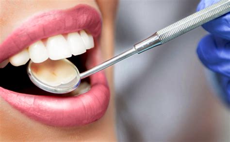 კბილების დაბჟენა