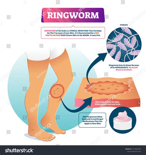 Vektor Stok Ringworm Vector Illustration Labeled Fungal Skin Tanpa