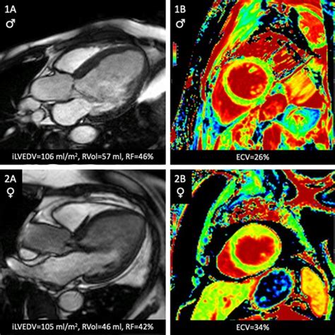 Sex Differences In Ecv According To Ar Severity Data Truncated For