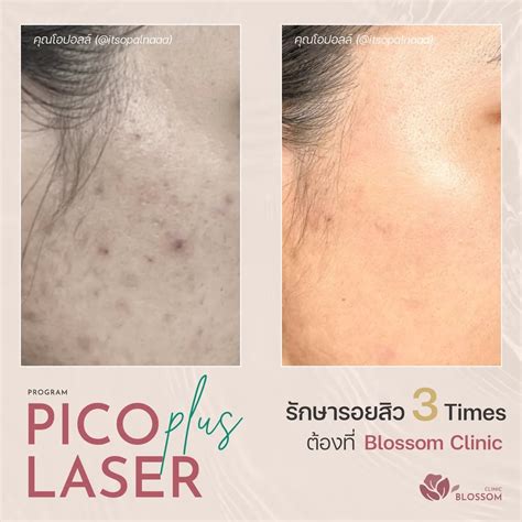 Pico Laser คออะไร ทำไมถงยอดนยม ลดกระ ฝา ท blossomclinic