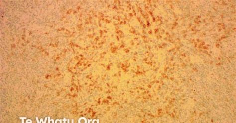 Immunohistochemistry Of Angioimmunoblastic T Cell Lymphoma Image