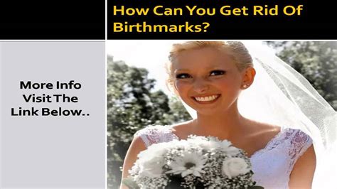 How Can You Get Rid Of Birthmarks YouTube
