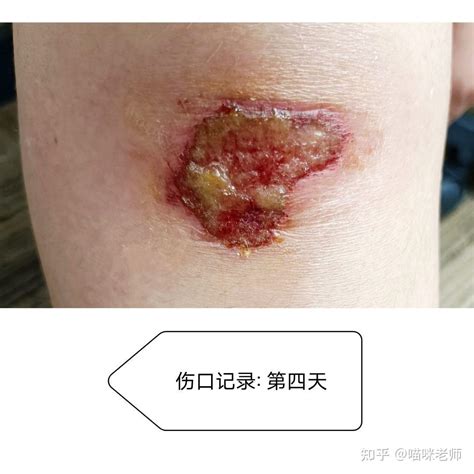 膝盖摔伤恢复记录记录恢复过程的皮肤变化 知乎