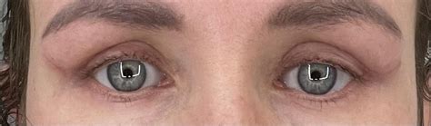 Upper Bleph Went Wrong Swelling 10 Days After Surgery Rplasticsurgery