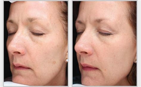 Sciton Halo Rochester Laser Treatment Rochester Ny Ocusight