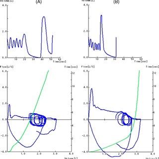 A Pretreatment Pulmonary Function Tests Showed Severe Upper Airway