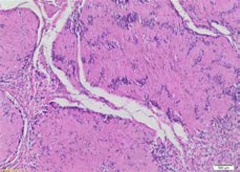 Streaming Fascicles Of Spindle Shaped Cells Forming Palisaded