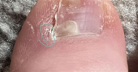 White Stuff Under Toenails