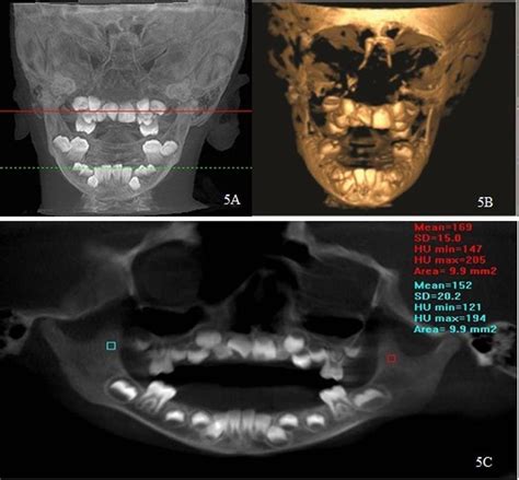 A B C Three Dimensional 3 D Cone Beam Computed Tomography Images Download Scientific