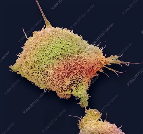 Cervical Cancer Cell Sem Stock Image F Science Photo Library