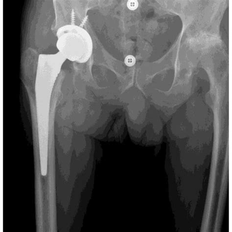 Pinnacle Cup And Corail Stem Implants Depuy Synthes Warsaw In Usa Download Scientific