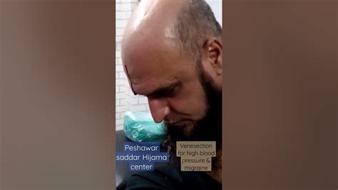 Hijama Medical Cupping Hairprp Treatment Viral Video Viralvideo