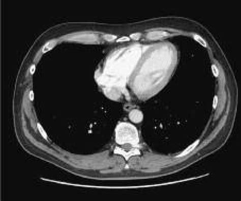 Preoperative Axial Mri Scan Of The Lower Thoracic Spine Showing A