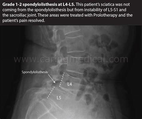 Spondylolisthesis Surgery Before And After