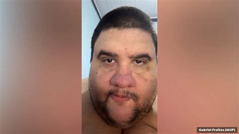 Muere Gabriel Freitas Influencer Que Pesaba Más De 300 Kilos Tras Un
