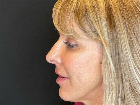 Facial Fat Grafting 1 Dr Zeshaan N Maan