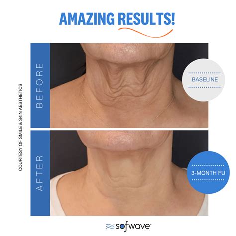 Sofwave Skin Tightening Treatment U S Dermatology Partners