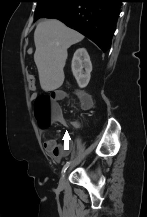 Volvulus Sigmoid