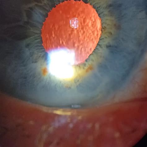 Retro Illumination Of Pco Or Clear View Optometry Pllc
