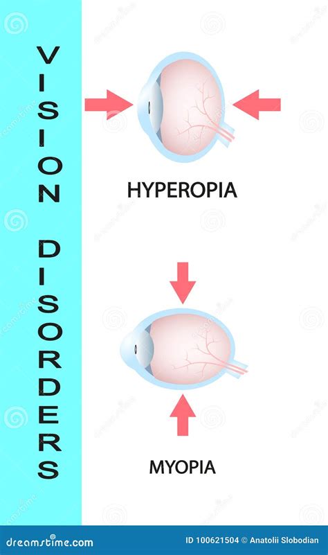 Hyperopia And Hyperopia Corrected By A Plus Lens Eye Vision Disorder Stock Vector