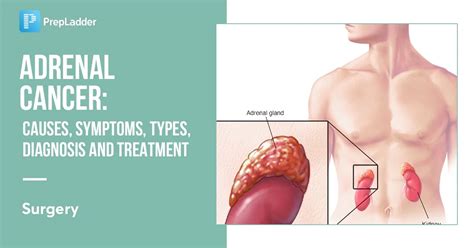 Adrenal Cancer Causes Symptoms Risk Factors Diagnosis