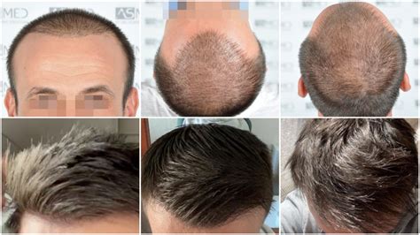 Norwood 6 Hair Transplantation Results Asmed Hair Transplant
