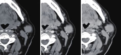A 60 Year Old Woman With Pleomorphic Adenoma In The Superficial Lobe Of