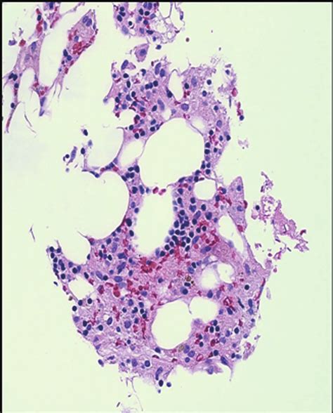 Bone Marrow Aspirate There Was No Evidence Of Dysplasia Residual
