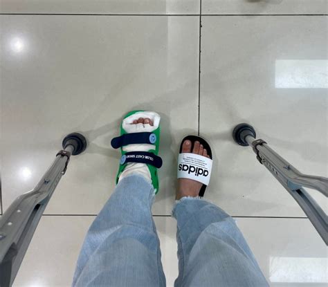 발목 인대 파열 완전파열부분파열 수술 없이 치료중 네이버 블로그