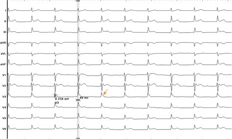 Ecg Of Patient Nr 2 Presenting With Early Repolarization Syndrome J Download Scientific