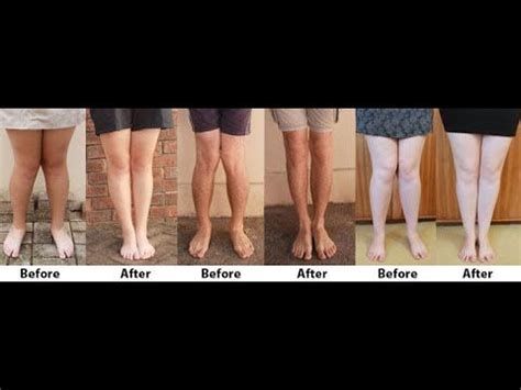 Knock Knees Exercises How Long Does It Take To Correct Knock Knees