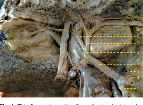 Figure 1 From Variations In Origin And Branching Pattern Of Hepatic Arteries And Their Clinical