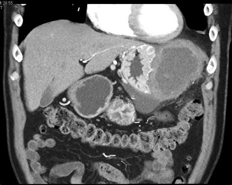 Ctisus On Linkedin Left Upper Quadrant Abscess Near The Spleen And