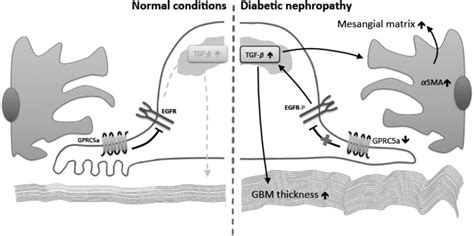 Depletion Of Gprc5a Promotes Development Of Diabetic Nephropathy Pmc